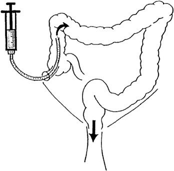 الحقنة الشرجية – Mustadeem – مستديم